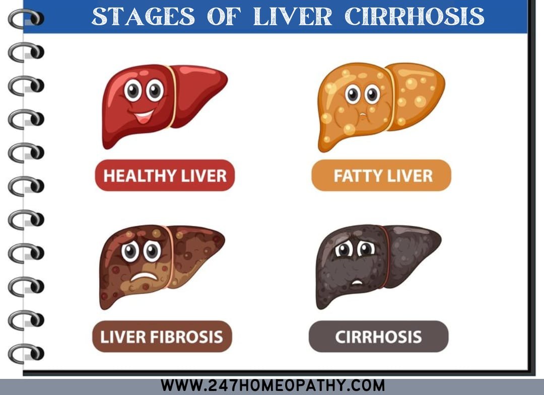 Cirrhosis Of Liver - 247homeopathy